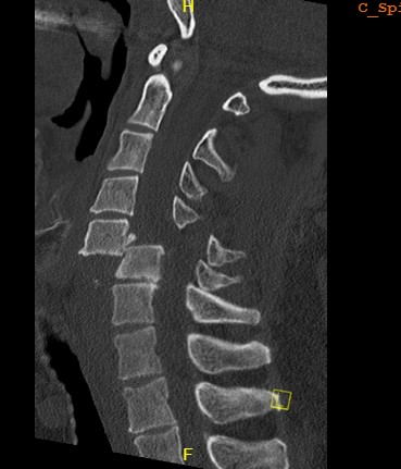 Bilateral Facet Fracture